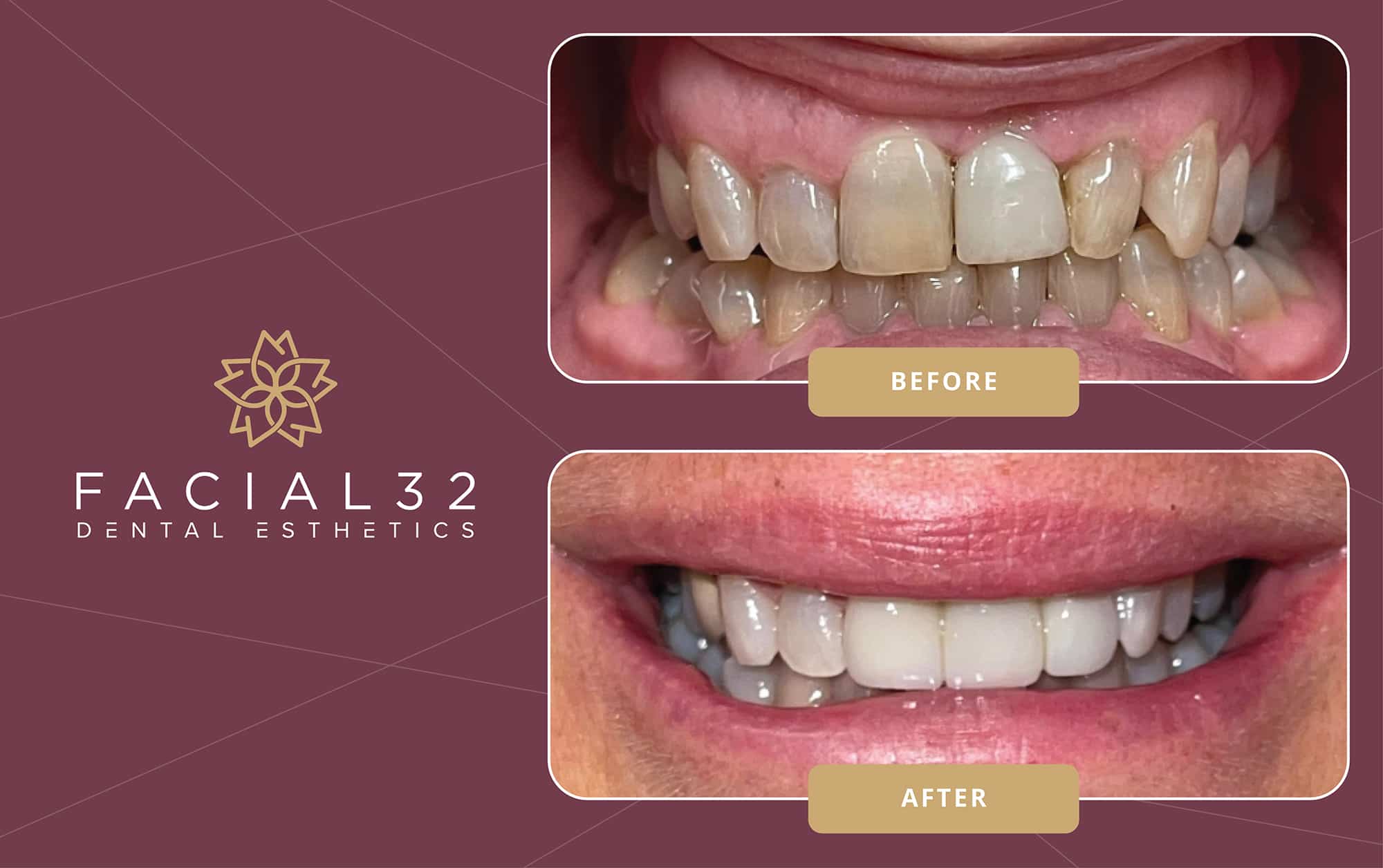 How to stop grinding teeth at night? Before it's too late