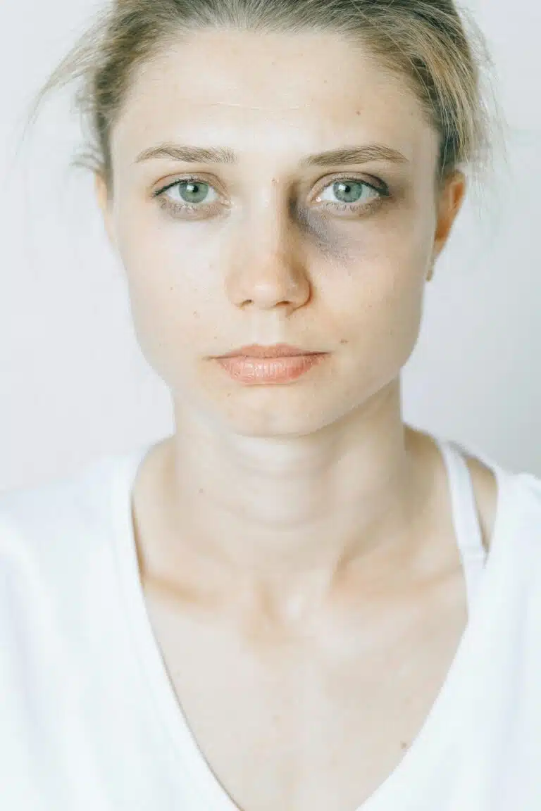 Bruising After Botox: Normal or Red Flag (Bad)?